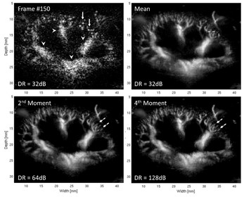 Super-Resolution without contrast agents in US - SAMPL